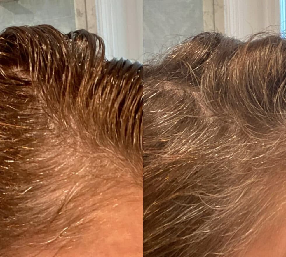 PRP Injections for Face | Newport Beach, CA | Armstrong MD