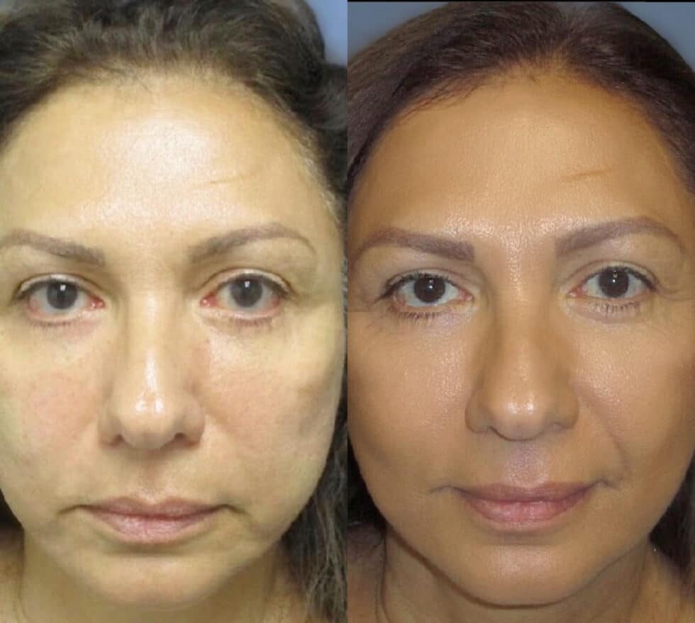 Daxxify - Dr. Jen Armstrong