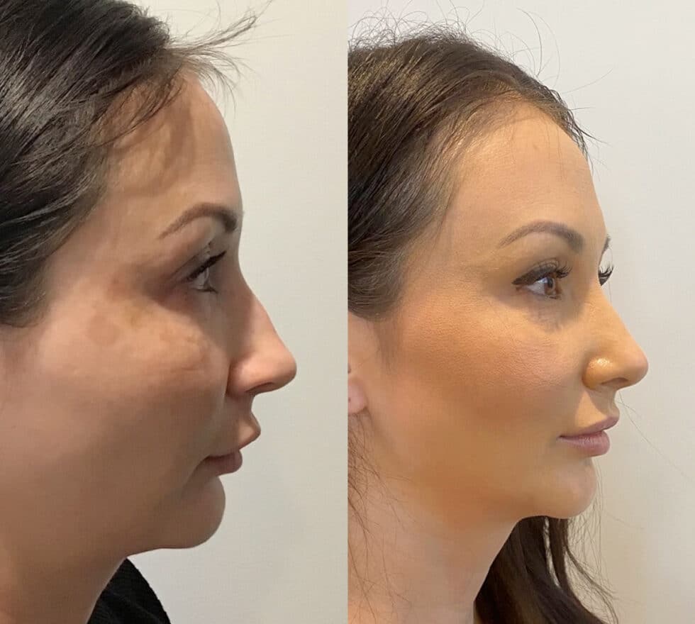 #1 Injectables Overview | Newport Beach, CA | Armstrong MD