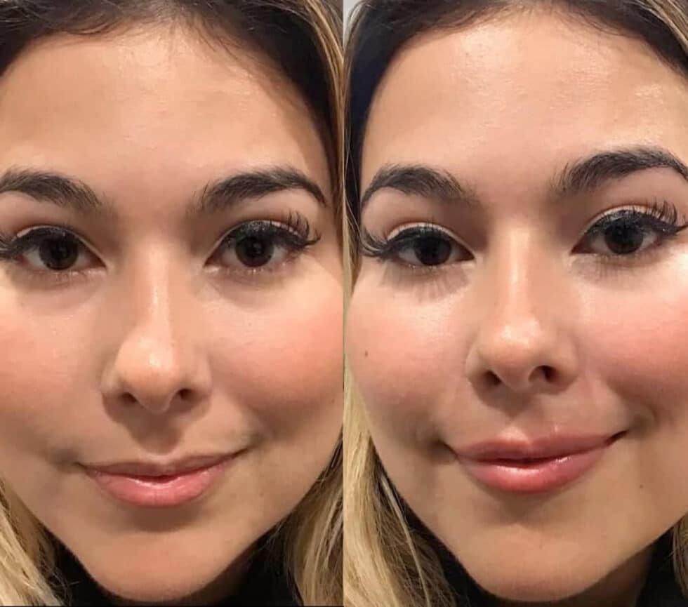 RHA Fillers - Dr. Jen Armstrong