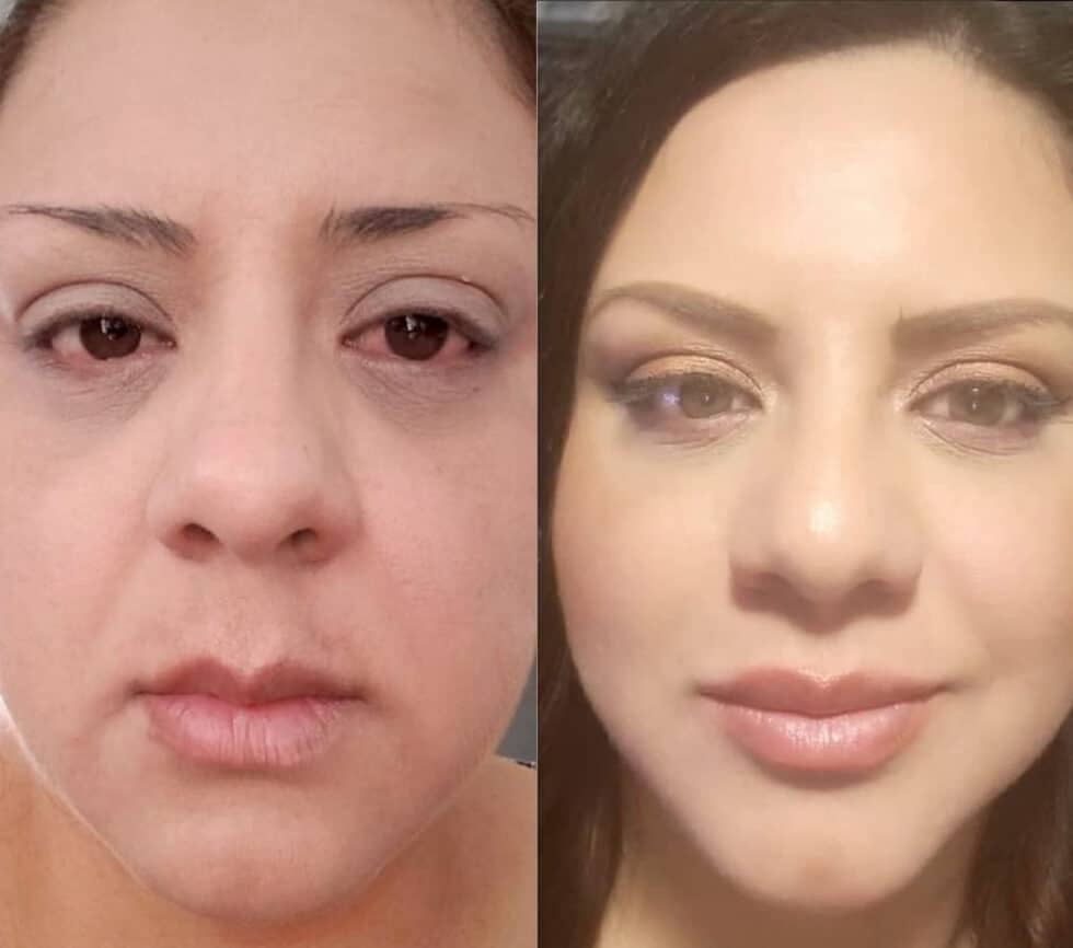 Versa Dermal Filler | Newport Beach, CA | Armstrong MD