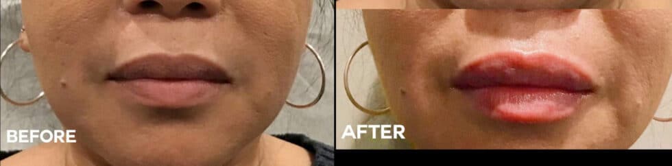 Versa Dermal Filler | Newport Beach, CA | Armstrong MD