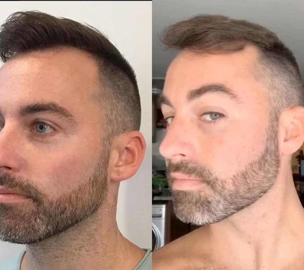 Threadlifts - Dr. Jen Armstrong