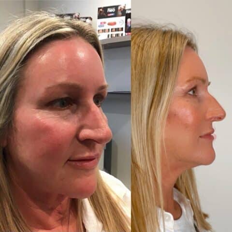 Threadlifts - Dr. Jen Armstrong